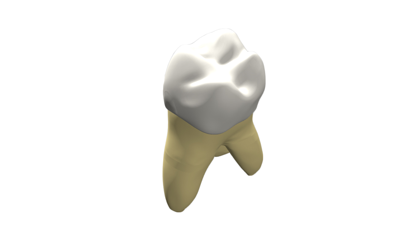 Dente 16 hígido - Open Dentistry